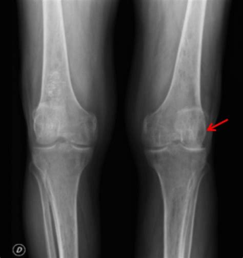 case 1 circle calcification and vacuum phenomenon in intervertebral