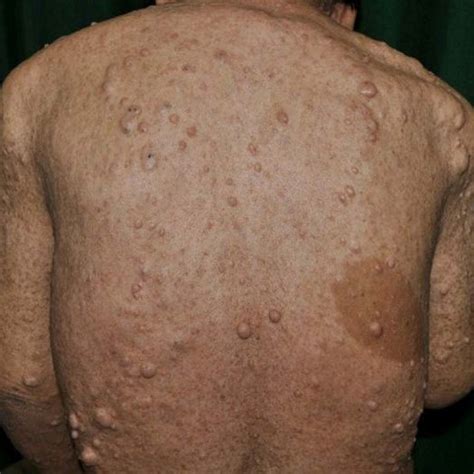 2 NF1 Manifestations The Disease Neurofibromatosis Type 1 NF1 Has