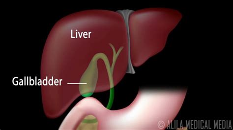 Gallstones And Surgical Removal Of Gallbladder Cholecystectomy Animation