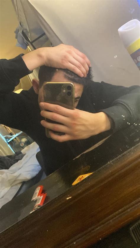 Is My Balding Reversible Left Side Seems Like Its Gone R Hairloss