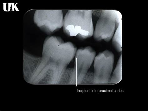 Ppt Radiology Of Caries Powerpoint Presentation Free Download Id