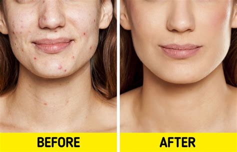 6 Natural Ways To Get Rid Of Pimples And Make Your Skin Happy Bright Side