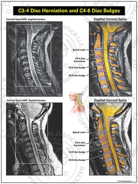 Cervical Disc Herniation C3 C4