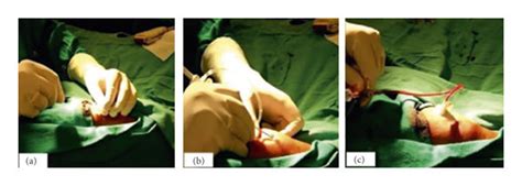 A Guidewire Inserted Via Seldinger Technique B Arterial Sheath Download Scientific