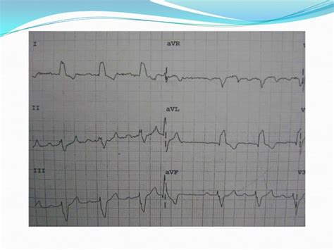 Ecg Trifascicular Block Pptx