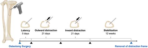 Schematic Drawing Of The Management For Tibial Cortex Transverse