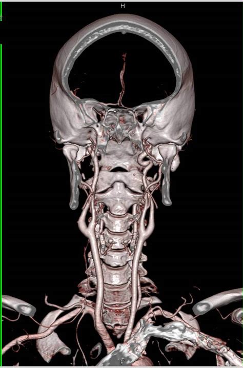 Normal Cta Of The Head And Neck Neuro Radiology Case Studies Ctisus