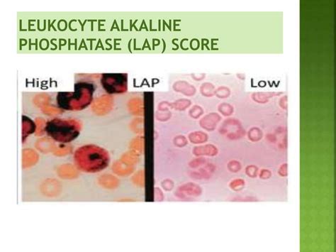 Leukemoid Reaction And Leukemia Pptx
