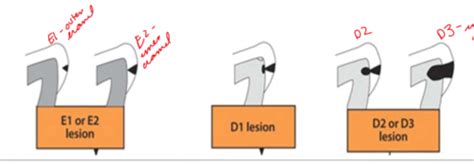 4 Caries Diagnosis Flashcards Quizlet