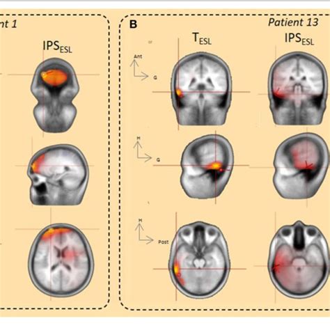 Esl Using The Dipole Fitting And Distributed Methods Clara Sslofo Download Scientific
