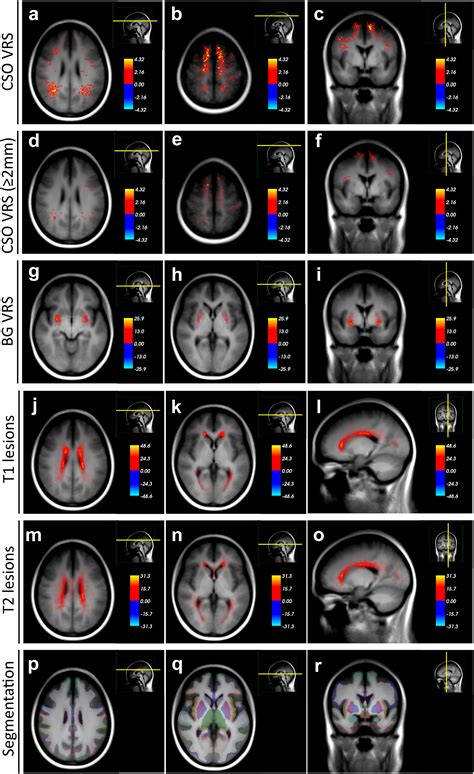 Dilated Virchow Robin Spaces Are A Marker For Arterial Disease In
