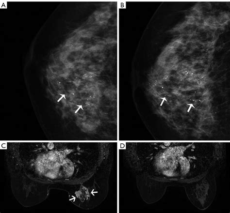 value of mammographic microcalcifications and mri enhanced lesions in