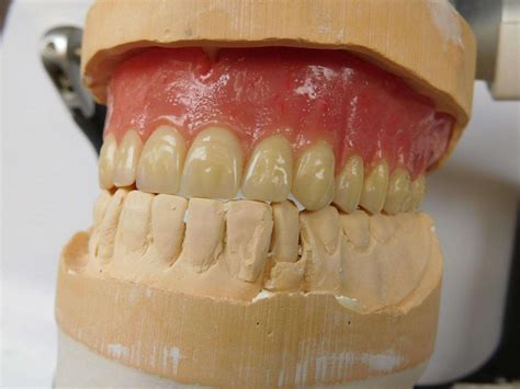 Efficiency And Accuracy In Denture Base Processing Keystone Industries