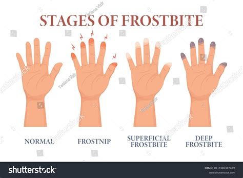 Vector Frozen Hands With Fingers Medical Frostbite Skin Burn Symptom