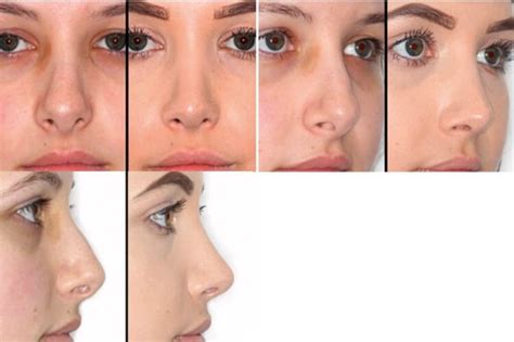 The Tip In Rhinoplasty Ent And Audiology News