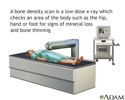 Bone Mineral Density Test Information Mount Sinai New York