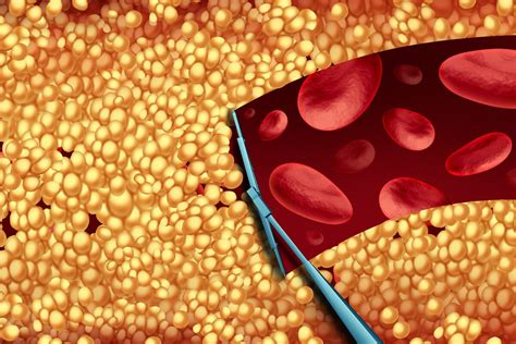 How Atherectomy Works And What Its Benefits Are