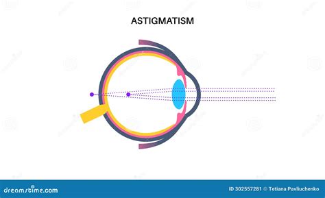 Astigmatism Eye Disease Stock Vector Illustration Of Pupil 302557281