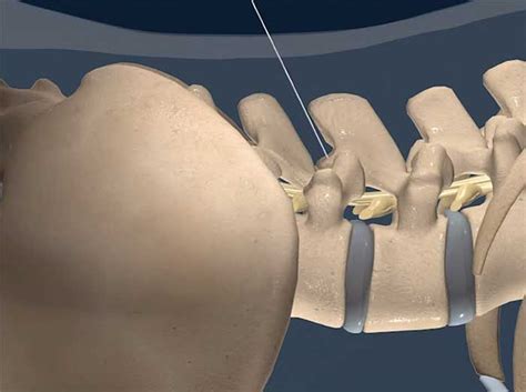 Choroidal Neovascularization Injection In Eye With Avastin Medivisuals Inc