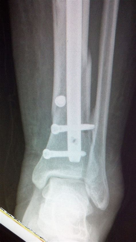 Distal Tibial Fractures Technique Of Im Nailing Wheeless 47 Off