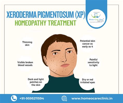 Xeroderma Pigmentosum Symptoms Causes And Homeopathic Medicines