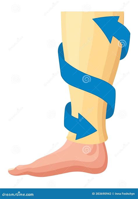 Stages Or Types Of Varicose Veins Development Medical Poster Or