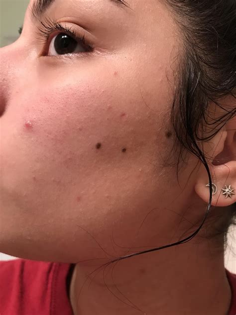 [routine Help] Skin Details And Current Routine In Comments R