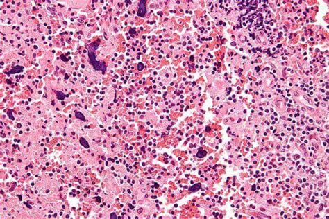 6 Types Of Lupus That Need To Be Known 2025