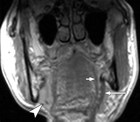 Masticator Space Ct And Mri Of Secondary Tumor Spread Ajr