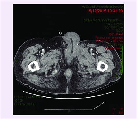 Abdomen CT Scan Performed In December 2015 Showing A Pathological Download Scientific Diagram