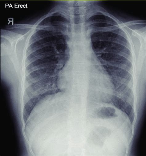 Chest X Ray Nine Months Post Discharge Showed Persistent Fine Reticular
