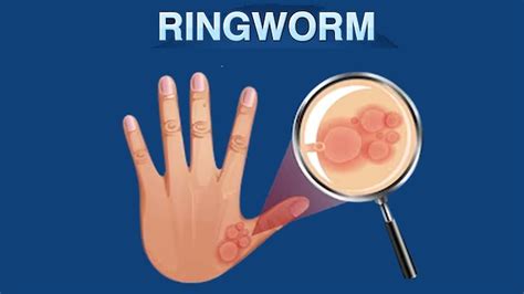 Why Ringworm Is Caused