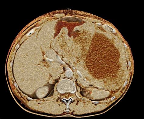 Ulcerating Gastric Gist Tumor Stomach Case Studies Ctisus Ct Scanning