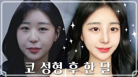 한 달 만에 완벽 회복👀 매부리코and복코교정하고 이미지 완전 바뀜 쀼 Youtube