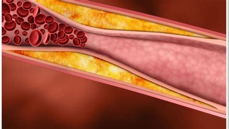 Arquivos Dislipidemia Cirurgião Vascular