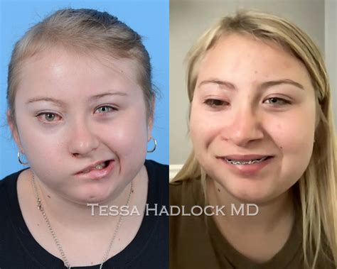 Patient Qiri3dxertghptlxyxvajw Gracilis Before And After Photos Hadlock Facial Plastic Surgery