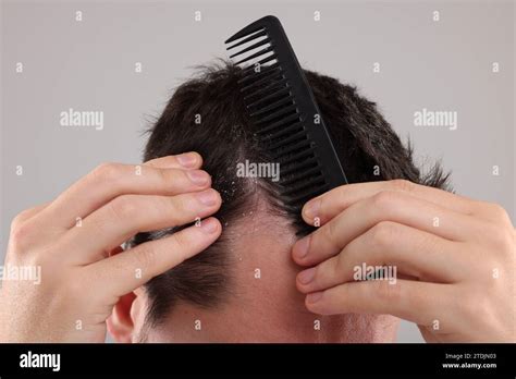 Dandruff Problem Man With Comb Examining His Hair And Scalp On Light Gray Background Closeup