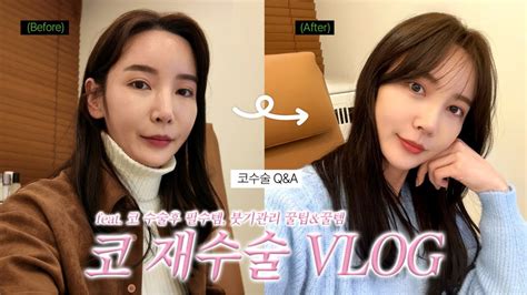 코 재수술 Vlog 죽다 살아난 재수술 통증 후기부터 코수술 후 필수템 붓기관리 꿀팁 And 꿀템 Youtube