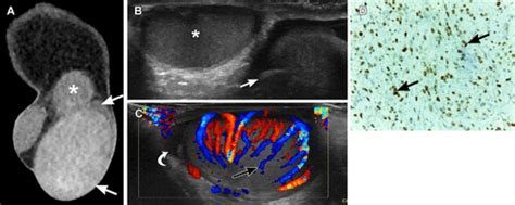 Soft Tissue Sarcomas Of The Genitourinary Tract With Radiologic Pathologic Correlation