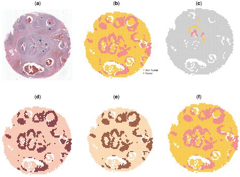 Analysis On Human Breast Cancer Dataset A Histology Image B