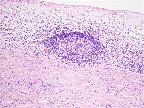 Understanding Calcified Fibroids Symptoms Diagnosis And Treatment Options