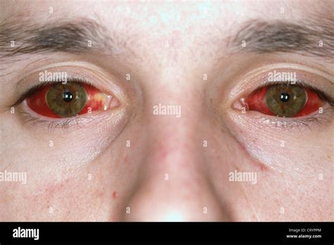 VIRAL CONJUNCTIVITIS Stock Photo 49168412 Alamy