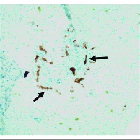 Hepatobiliary Iminodiacetic Acid Scan Images At 30 Minutes 60 Minutes