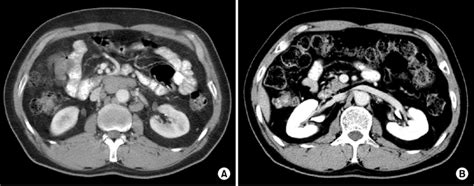 Computed Tomography Ct Scan Demonstrates Multiple Enlarged Lymph