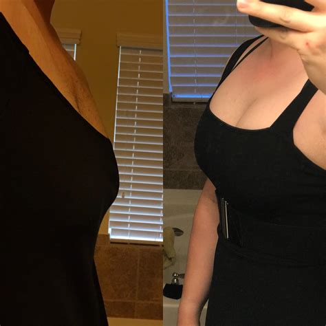 Transgender Mtf Breast Growth Telegraph