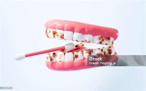 Human Teeth Model Dental Plaque Dental Calculus 3d Rendering Stock