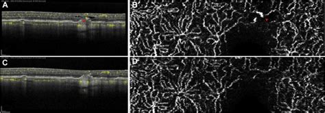 High Resolution Oct Angiography Features Of An Early Type 3 Neovascularization Ophthalmology