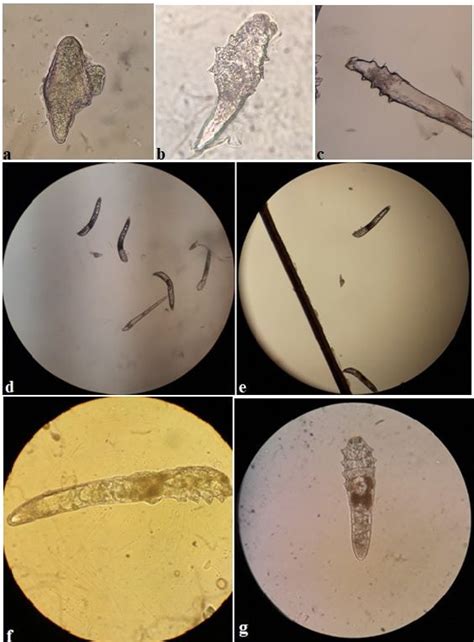 Prevalence Of Demodex Folliculorum And Demodex Brevis In Patients With Blepharitis And Chalazion