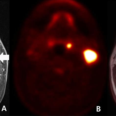 Initial Work Up Of A 54 Year Old Man With Left Palatine Tonsillar