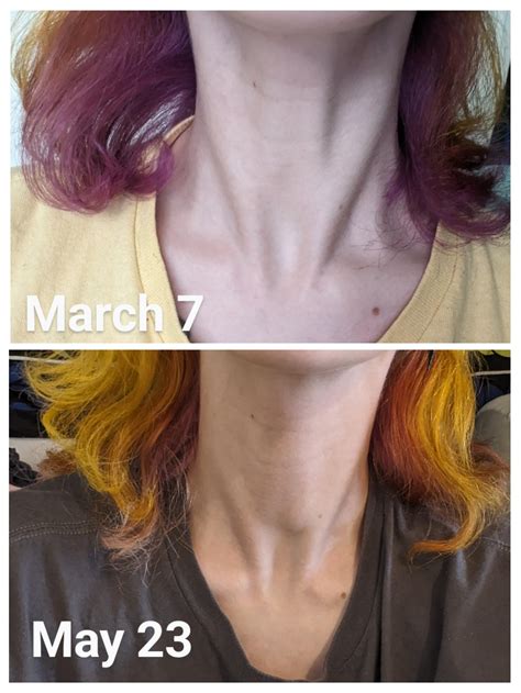 Nodule Growth Rthyroid